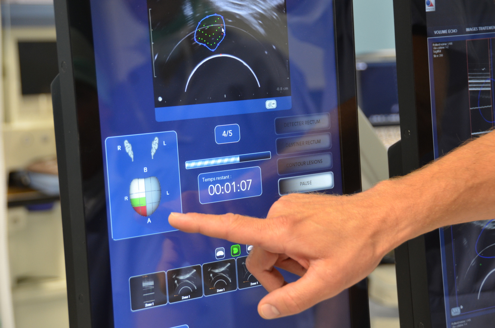 UroNav darcq bailly henry urologie prostate biopsie-005 • macommune.info