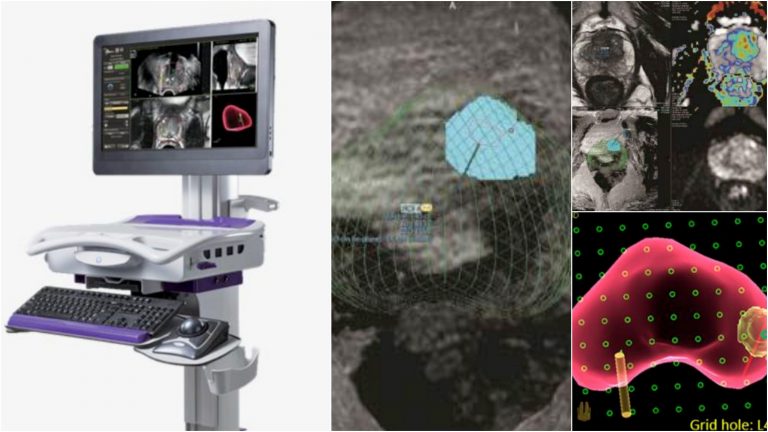 urologie biopsie prostate Uronav • macommune.info