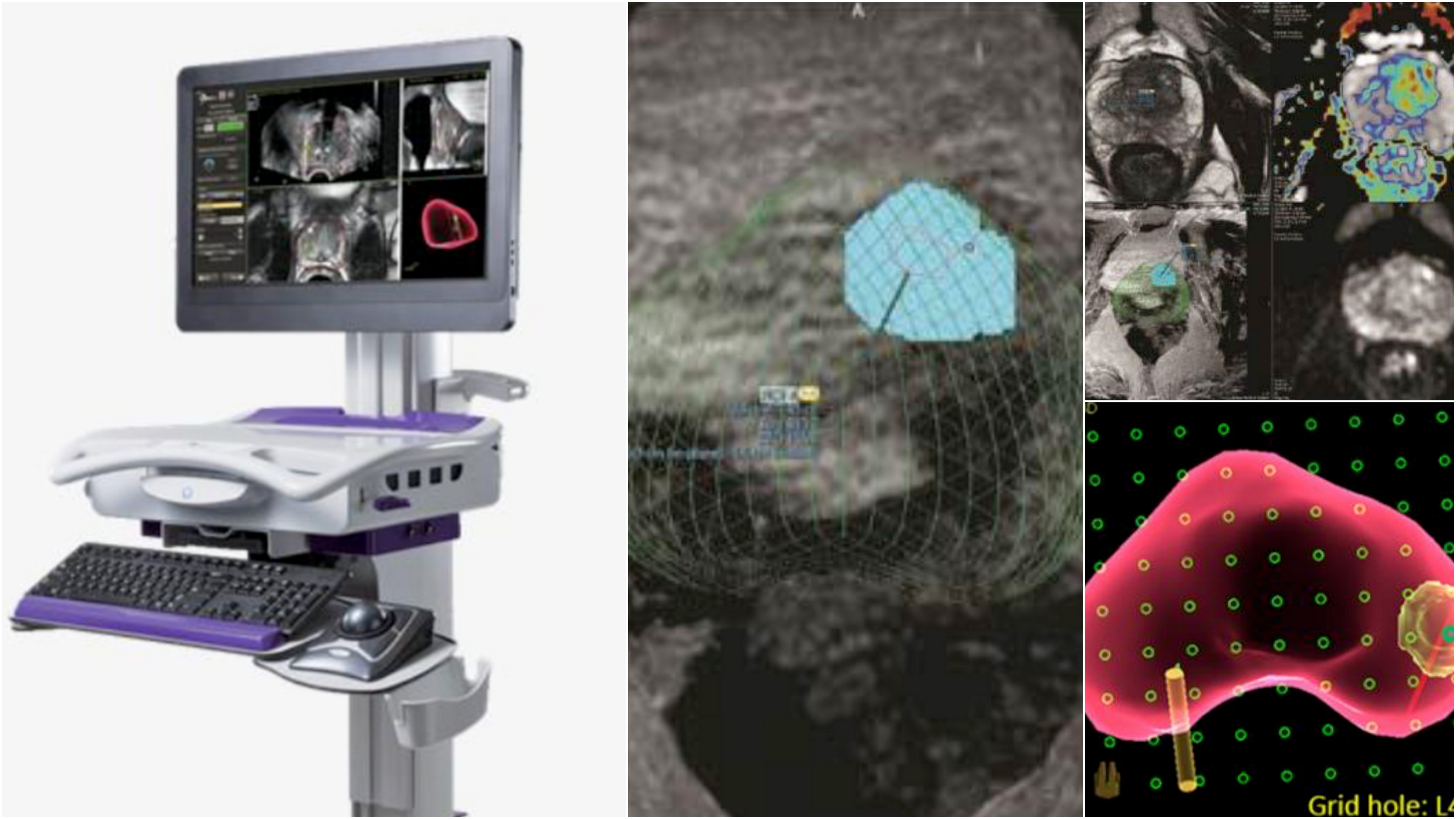 urologie biopsie prostate Uronav • macommune.info